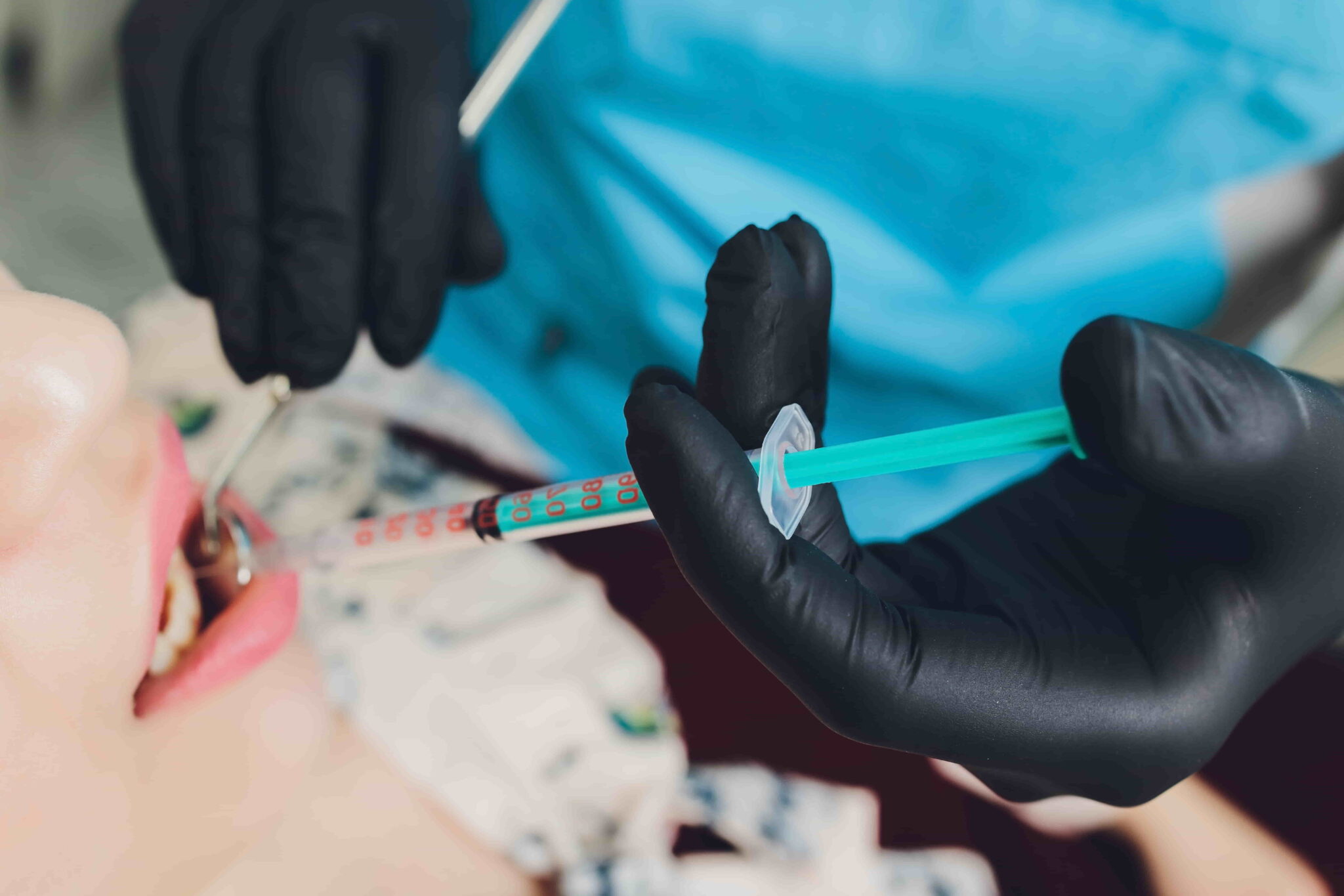 Guide to Wisdom Teeth Removal | Totally Teeth Dentist